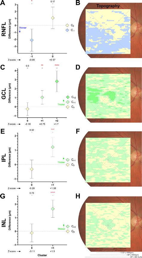 Figure 1 From Reticular Pseudodrusen Are Associated With More Advanced