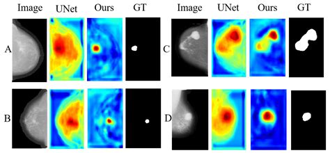 Attention Based Active Learning Framework For Segmentation Of Breast Cancer In Mammograms