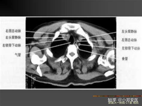 从0到1带你学会读ct片之呼吸系统影像学诊断（科普） 知乎