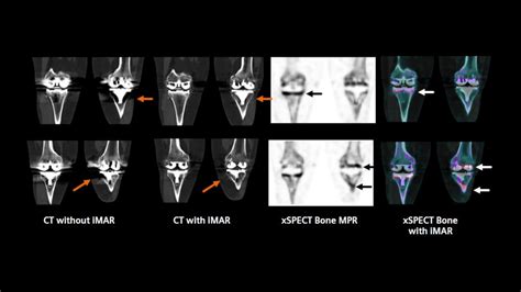spect ct detection in tka prosthetic loosening siemens healthineers usa