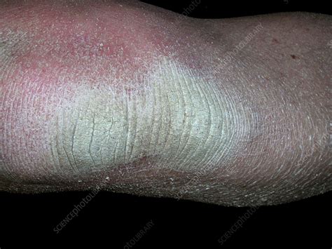 Acquired Ichthyosis Stock Image C056 7892 Science Photo Library