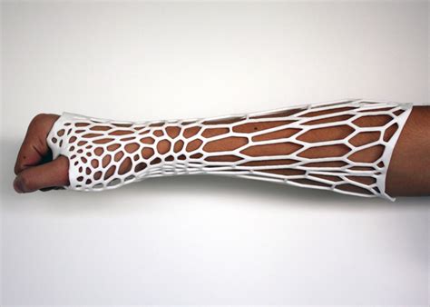 cortex 3d printed cast for fractured bones by jake evill
