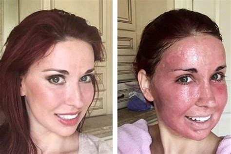 قرمزی پوست بعد از لیزر 7 راهکار برای درمان التهاب پوست بعد از لیزر