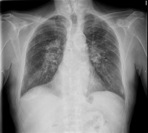 Eggshell Calcification