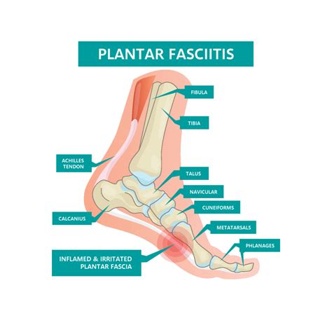Plantar Fasciitis Diagram • Liz Tough Clinic