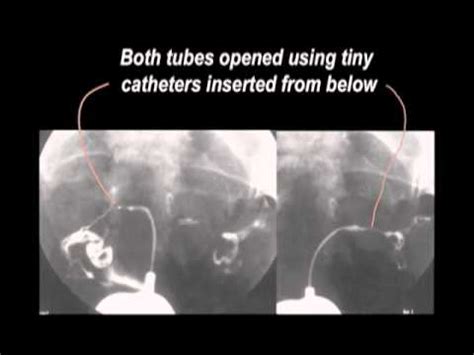 UCSF Radiology Interventional Radiology Treatment For Blocked Fallopian Tubes YouTube