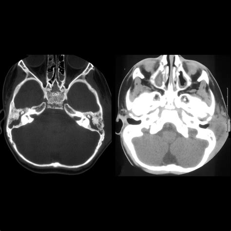 Pediatric Acute Mastoiditis Pediatric Radiology Reference Article