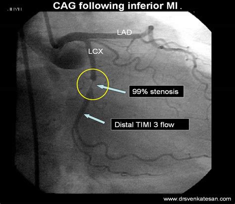lcx meddic