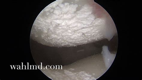 Cartilage Grading Outerbridge Scale — Christopher J Wahl Md