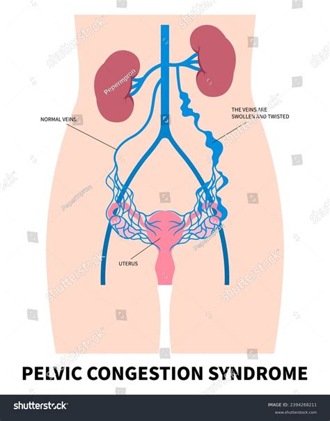 Menstruation Infection Disease Endometrium Ovary Fibroid Stock Vector