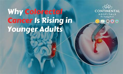 ¿Por qué el cáncer colorrectal está aumentando entre los adultos jóvenes?