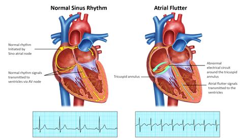 Atrial Flutter Dr Hari Sugumar Electrophysiologist And Cardiologist