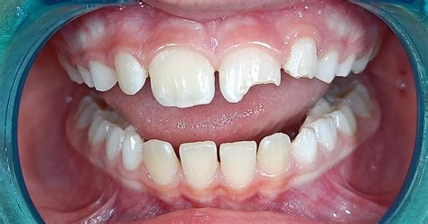 Прочети за Възстановяване на счупени предни зъби при деца Noradent