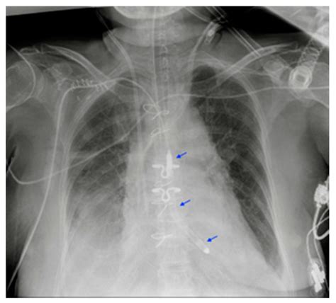 Diagnostics Special Issue Chest X Ray Detection And Classification