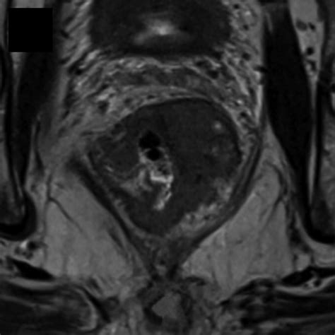 Colon Cancer Mri