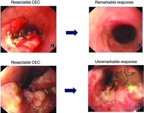 Endoscopy Evaluation Rr Remarkable Response Patients Are Considered