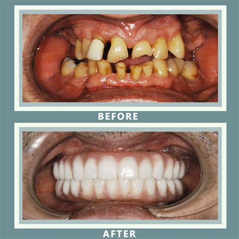 Dental Implant Before And After