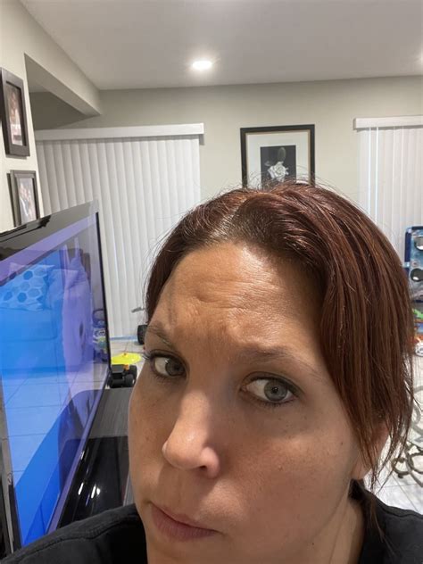 Primary Hypertrophic Osteoarthropathy It Began With An Indent On My