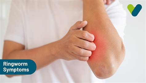 Ringworm Symptoms Discover The Signs And Symptoms Of Ringworm Disease