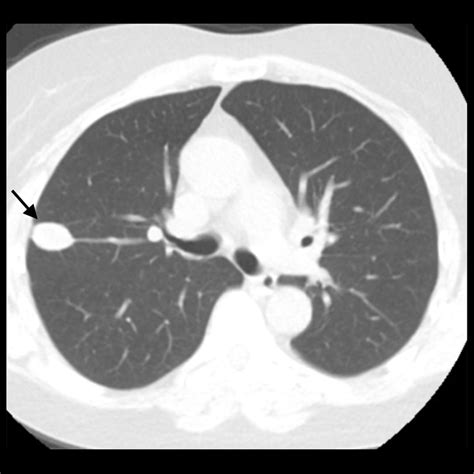 Ct Scan Chest Without Contrast Ct Chest Without Contrast Showing