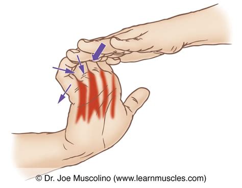 Intrinsic Hand Strength Exercises At Darcy Ryan Blog