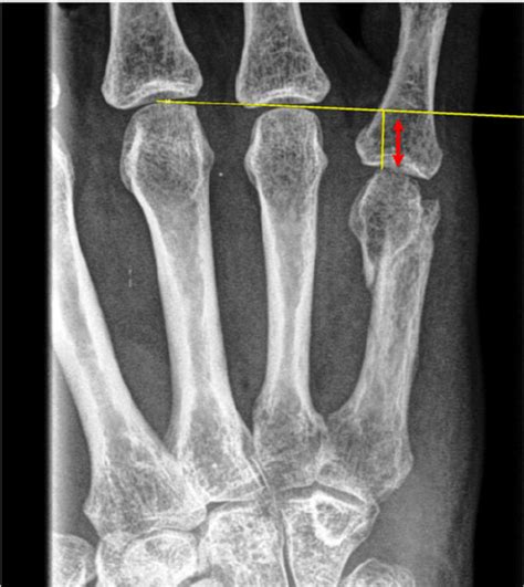Ap Measurement Of A Subcapital Fracture Of The 5th Metacarpal Showing A Download Scientific