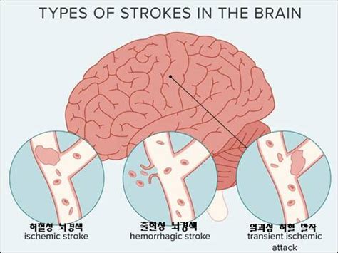 뇌혈관이 막히는 뇌경색 환자 증가 뇌경색 원인 증상 치료 예방방법