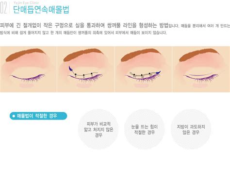 예진성형외과눈성형쌍꺼풀 수술