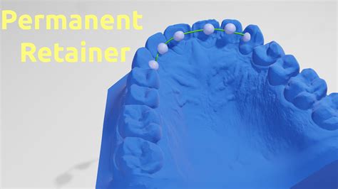 Is Permanent Retainer The Right Choice After Braces Dentadigest