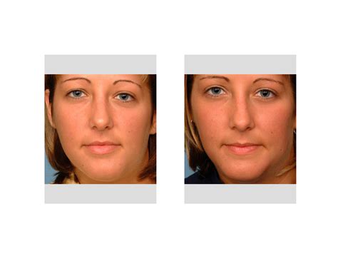 Correction Of Facial Asymmetry Dr Barry Eppley Indianapolis Explore