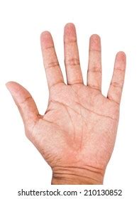 Palmar Erythema Left Hand Southeast Asian Stock Photo Shutterstock