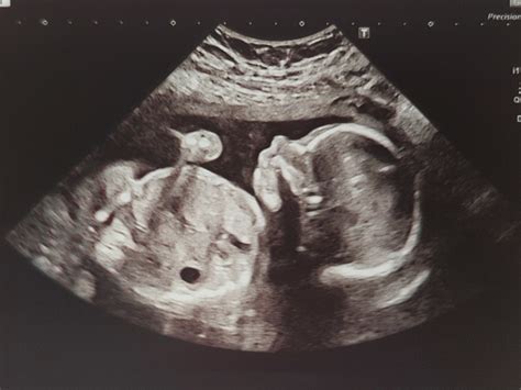 20 Week Scan Joy Rpredaddit