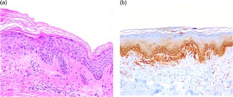 Diffuse Hyperpigmented Macules In A 48‐year‐old Woman Seguí 2024 Jeadv Clinical Practice