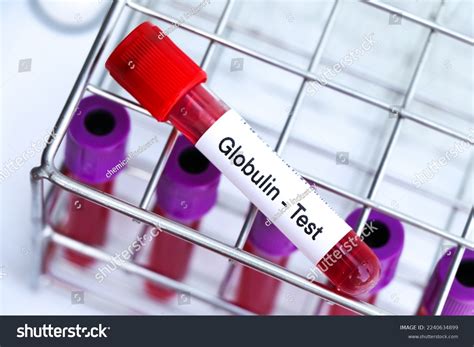 Globulin Test Look Abnormalities Blood Blood Stock Photo Shutterstock