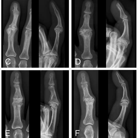Radiographs Ap View Of The Third Metacarpophalangeal Joint In The