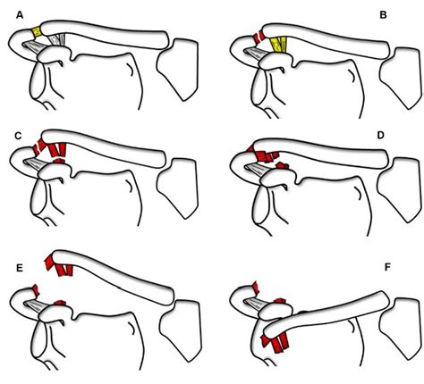 Acromioclavicular Joint Radiology Key