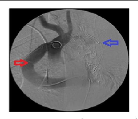 Figure 1 From Extra Anatomic Graft 12 Years After Ascending Descending