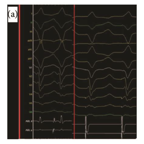 A Pacing Mapping Showed That The Morphology Of Pacing Qrs Complex Is Download Scientific