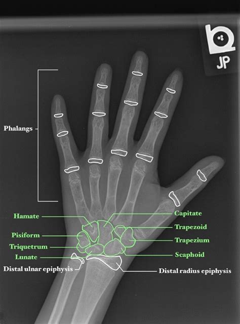 Convolutional Neural Network Based Automated Pediatric Bone Age