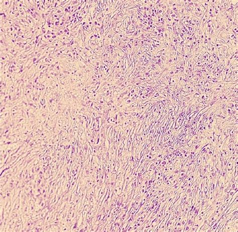 Photomicrograph Showing Extensive Areas Of Storiform Pattern Fibrosis Download Scientific
