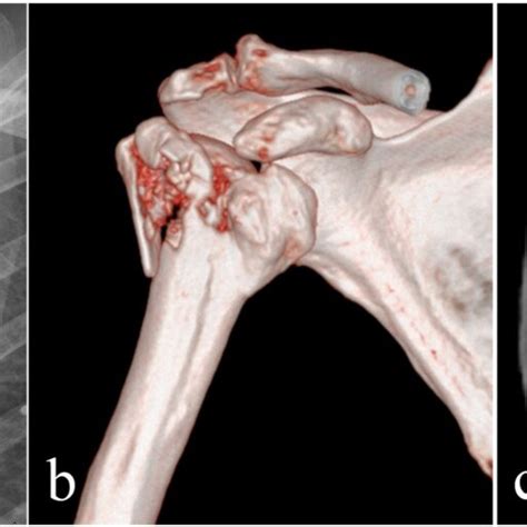 Female 72 Years Old With Neer 3 Part Valgus Fracture Of Proximal Download Scientific Diagram