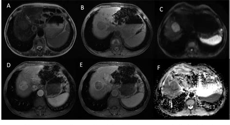 Figure 1 From Assessment Of Li Rads Efficacy In Classification Of Hepatocellular Carcinoma And
