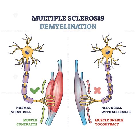 Multiple Sclerosis Demyelination Compared With Healthy Nerves Outline