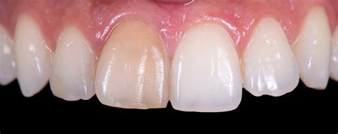 Tooth Discoloration Understanding The Causes Symptoms