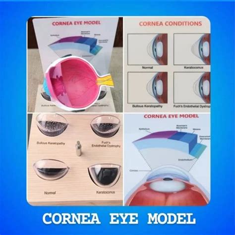 Keratoconus And Cataract Eye Model At ₹ 5500 Ophthalmic Training And Teaching Devices In Indore