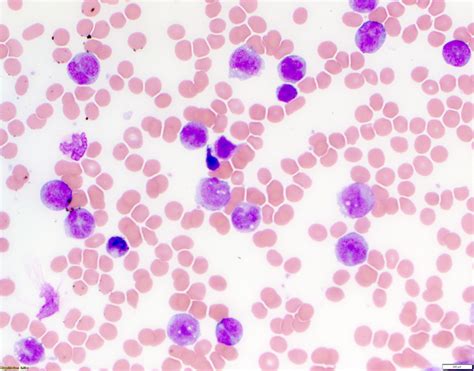 Pathology Outlines Aml With Other Kmt2a Rearrangements