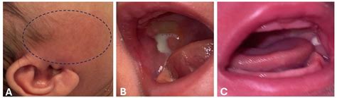 Bilateral Neonatal Suppurative Parotitis A Case Report And Review Of The Literature Heliyon