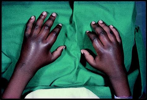 Understanding Sickle Cell Disease Causes Symptoms And Management
