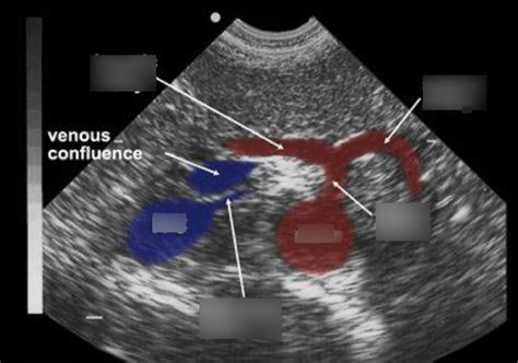 Celiac Artery Diagram Diagram Quizlet