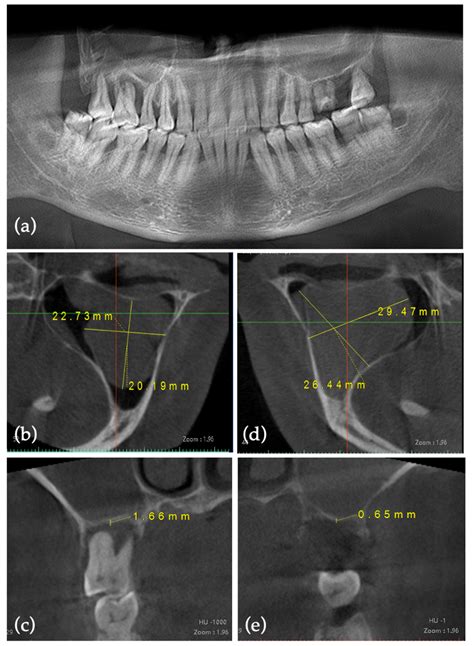 Giant Maxillary Sinus Cyst Removal With Simultaneous External Maxillary
